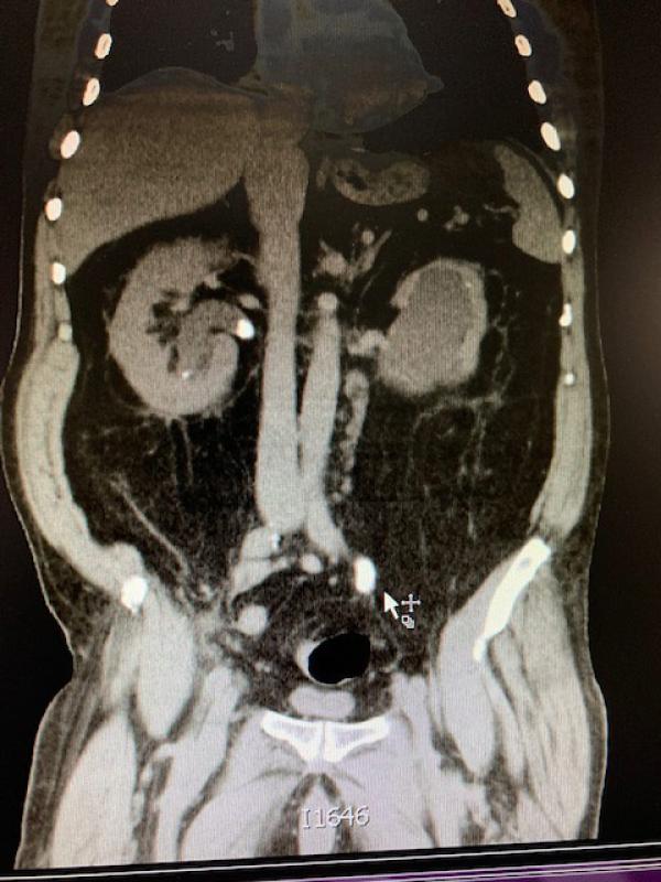 ΟΥΡΟΛΟΓΟΙ – ΧΕΙΡΟΥΡΓΟΙ –ΚΑΡΚΙΝΟΣ ΟΥΡΟΔΟΧΟΥ ΚΥΣΤΕΩΣ